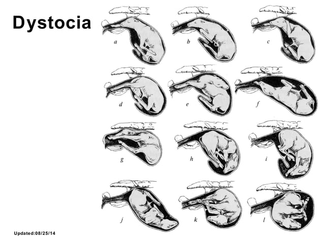 Fetal causes of dystocia | PPT