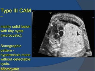 Fetal chest.pptx