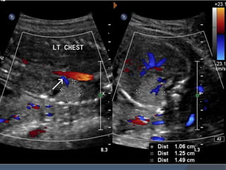 Fetal chest.pptx
