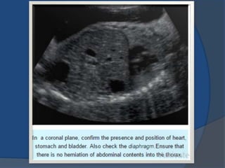 Fetal chest.pptx