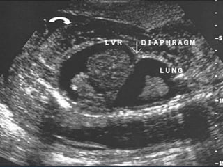 Fetal chest.pptx