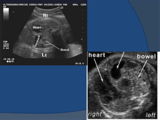Fetal chest.pptx