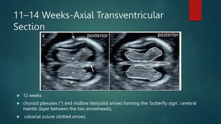 Fetal cns ppt.pptx