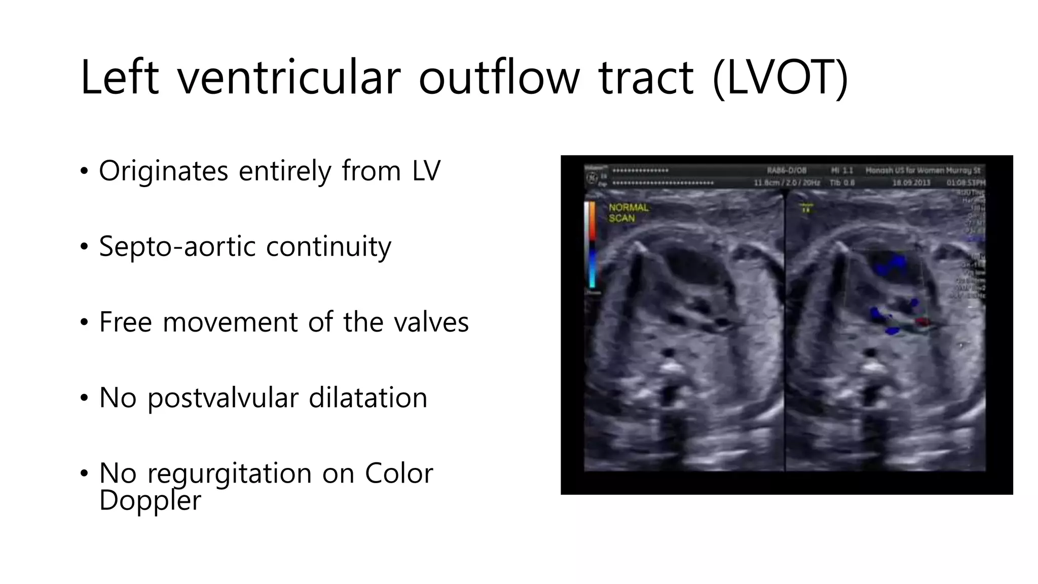 Fetal echocardiography | PPTX
