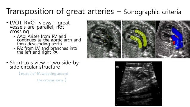 Fetal echocardiography