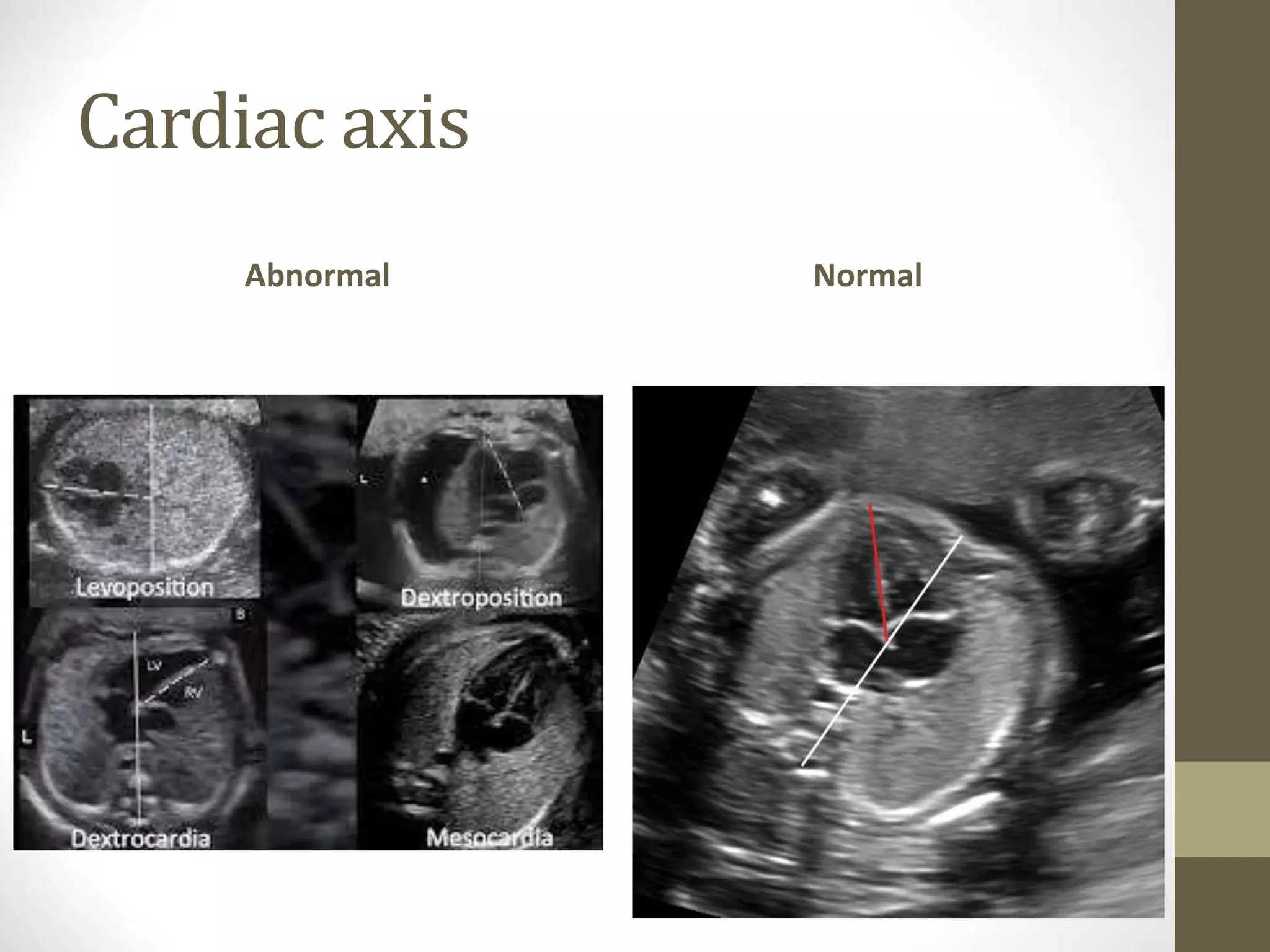 Fetal echocardiography.ppt