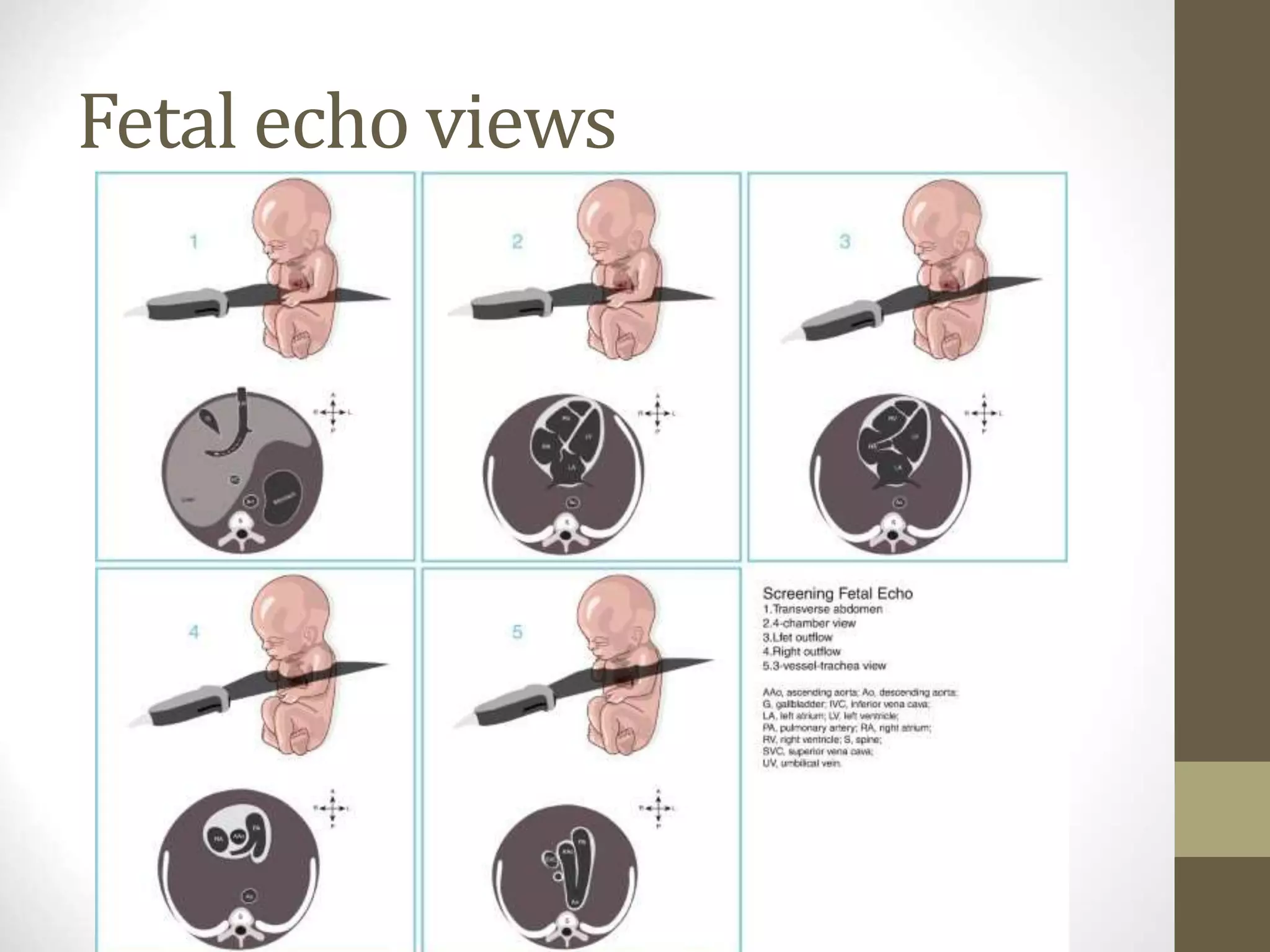 Fetal echocardiography.ppt
