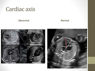 Fetal echocardiography.ppt