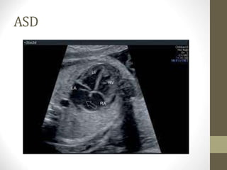Fetal echocardiography.ppt | Pregnancy | Reproductive Health