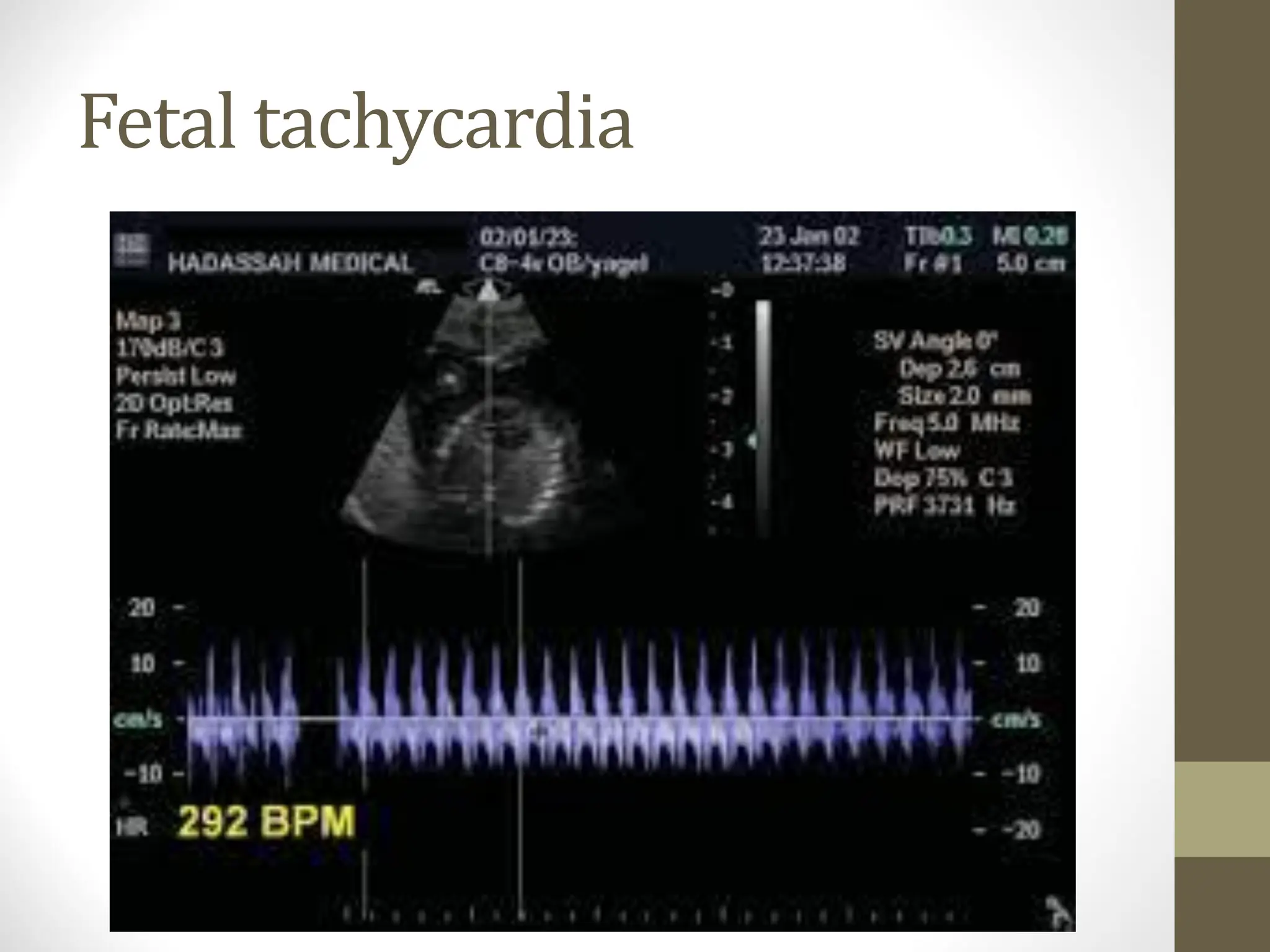 An introduction to Fetal echocardiography | PDF