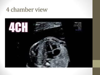 An introduction to Fetal echocardiography | PDF