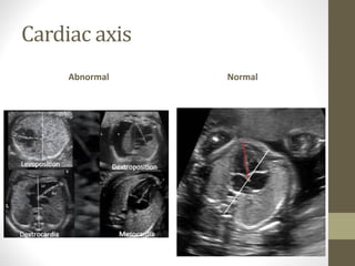An introduction to Fetal echocardiography | PDF