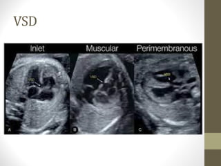 An introduction to Fetal echocardiography | PDF