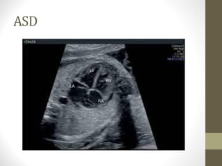 An introduction to Fetal echocardiography | PDF