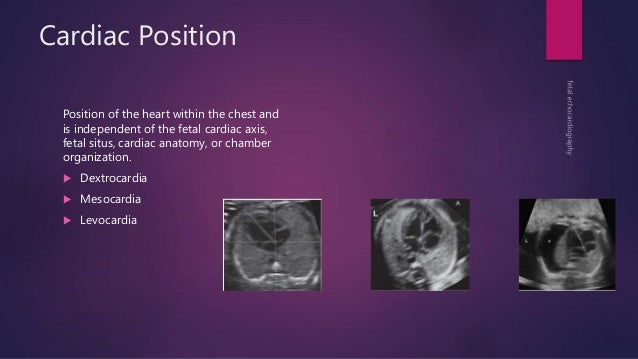 Fetal Echocardiography: Basics and Advanced