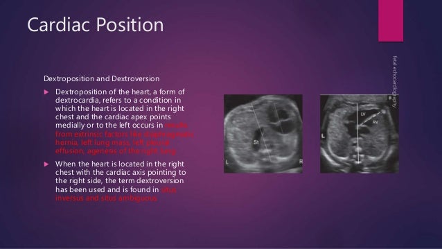 Fetal Echocardiography: Basics and Advanced