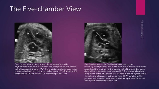 Fetal Echocardiography: Basics and Advanced