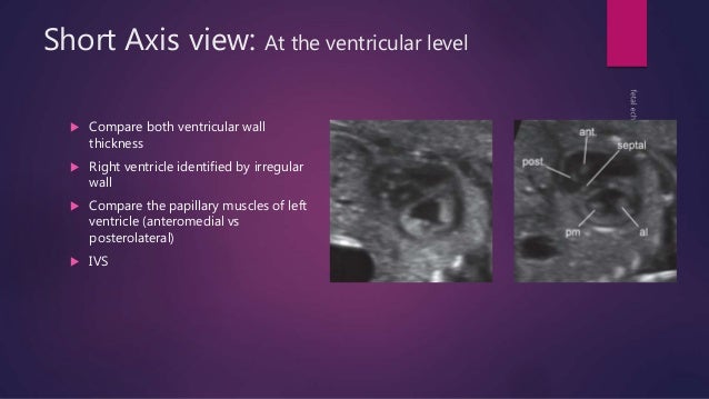 Fetal Echocardiography: Basics and Advanced