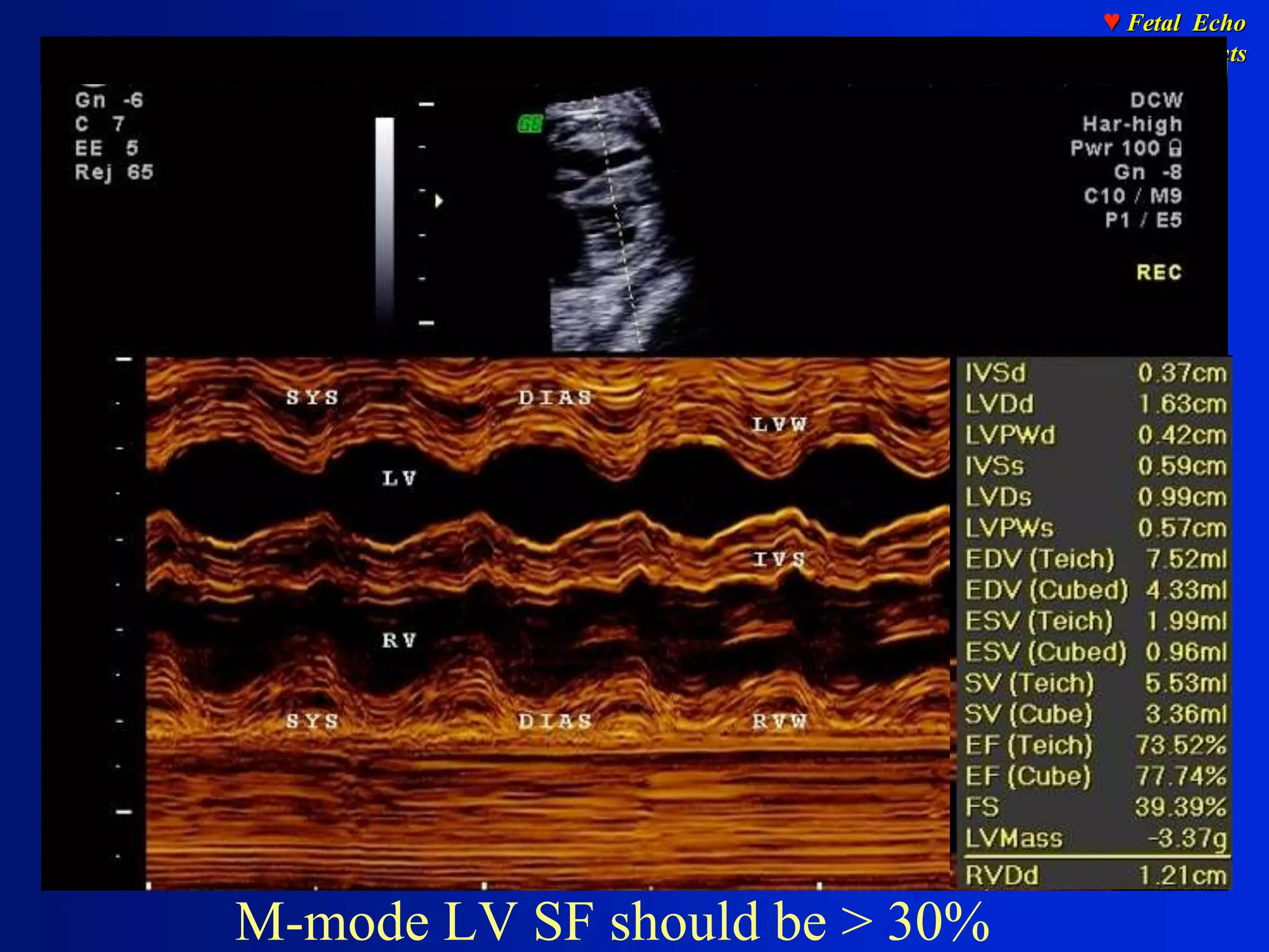 Fetal echo measurments | PPTX