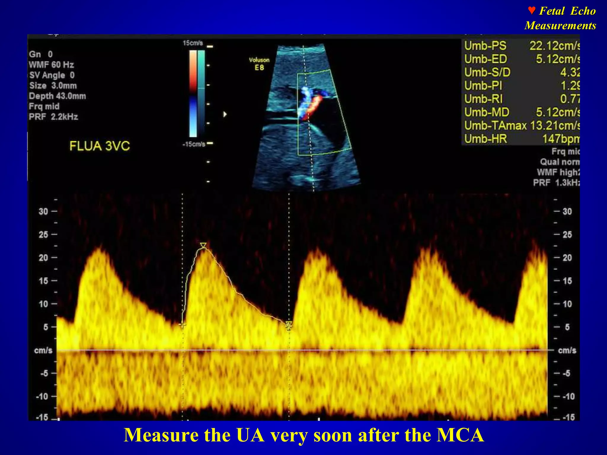 Fetal echo measurments | PPTX
