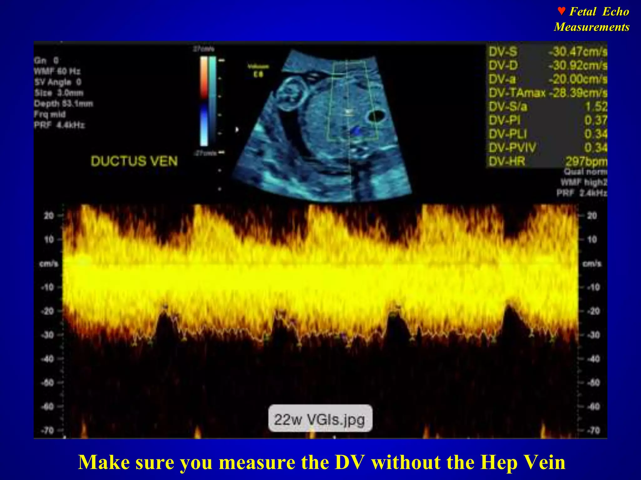 Fetal echo measurments | PPTX