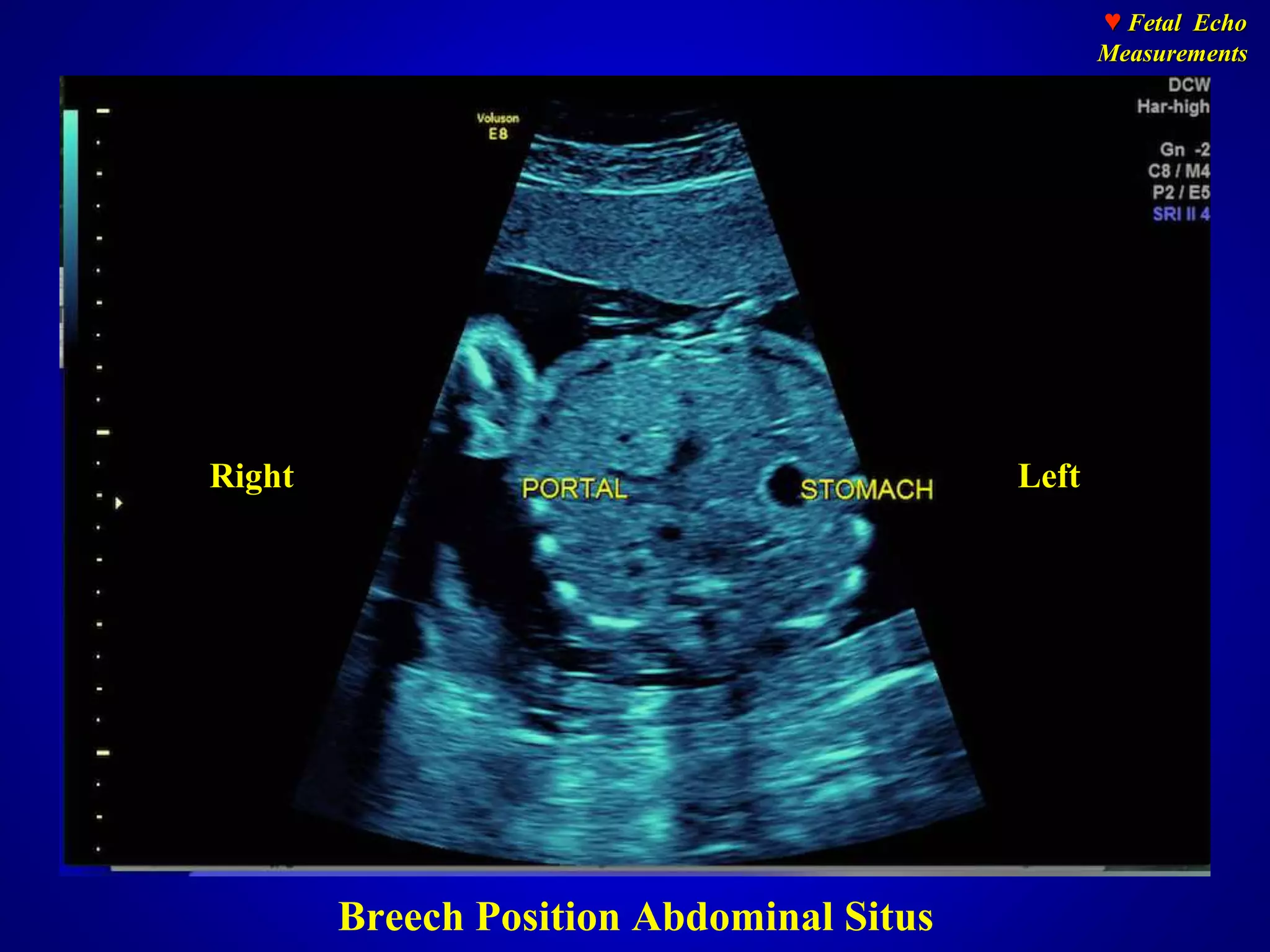 Fetal echo measurments | PPTX