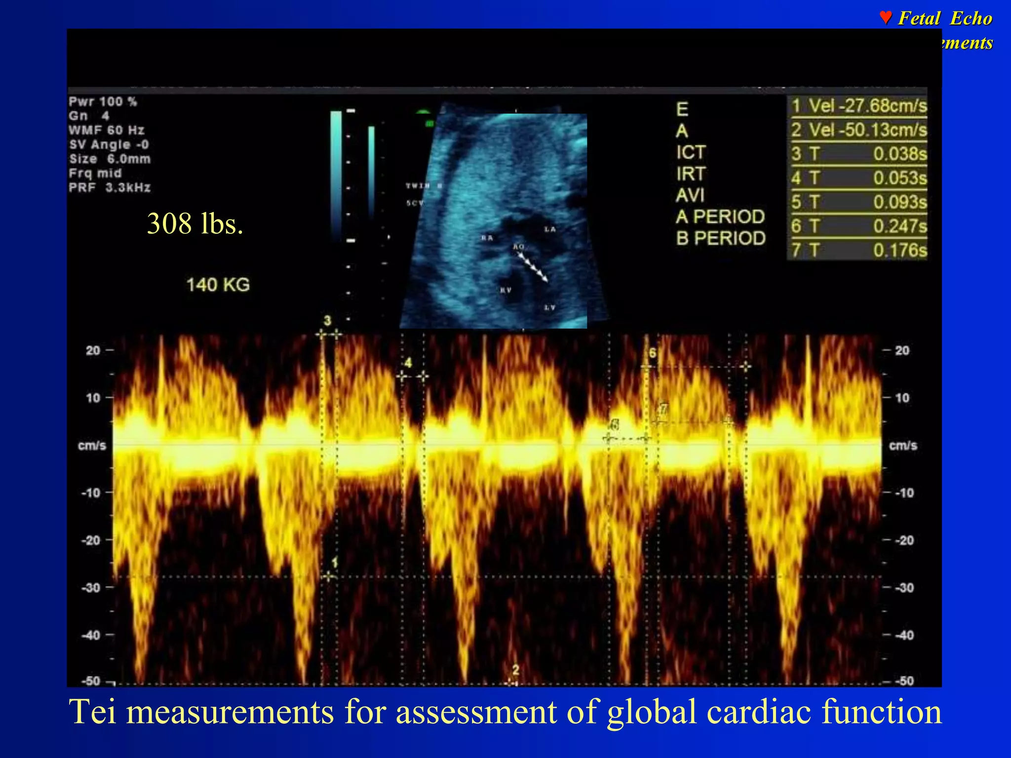 Fetal echo measurments | PPTX
