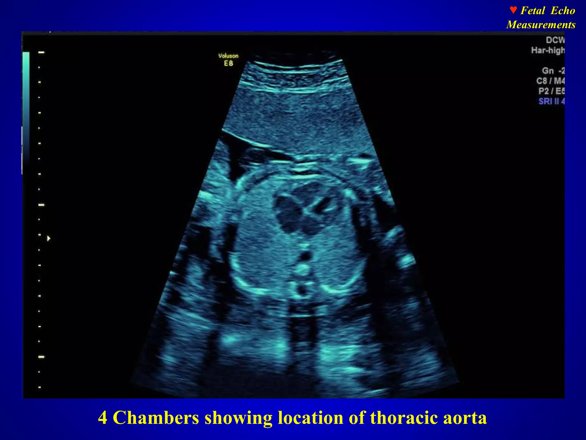Fetal echo measurments | PPTX