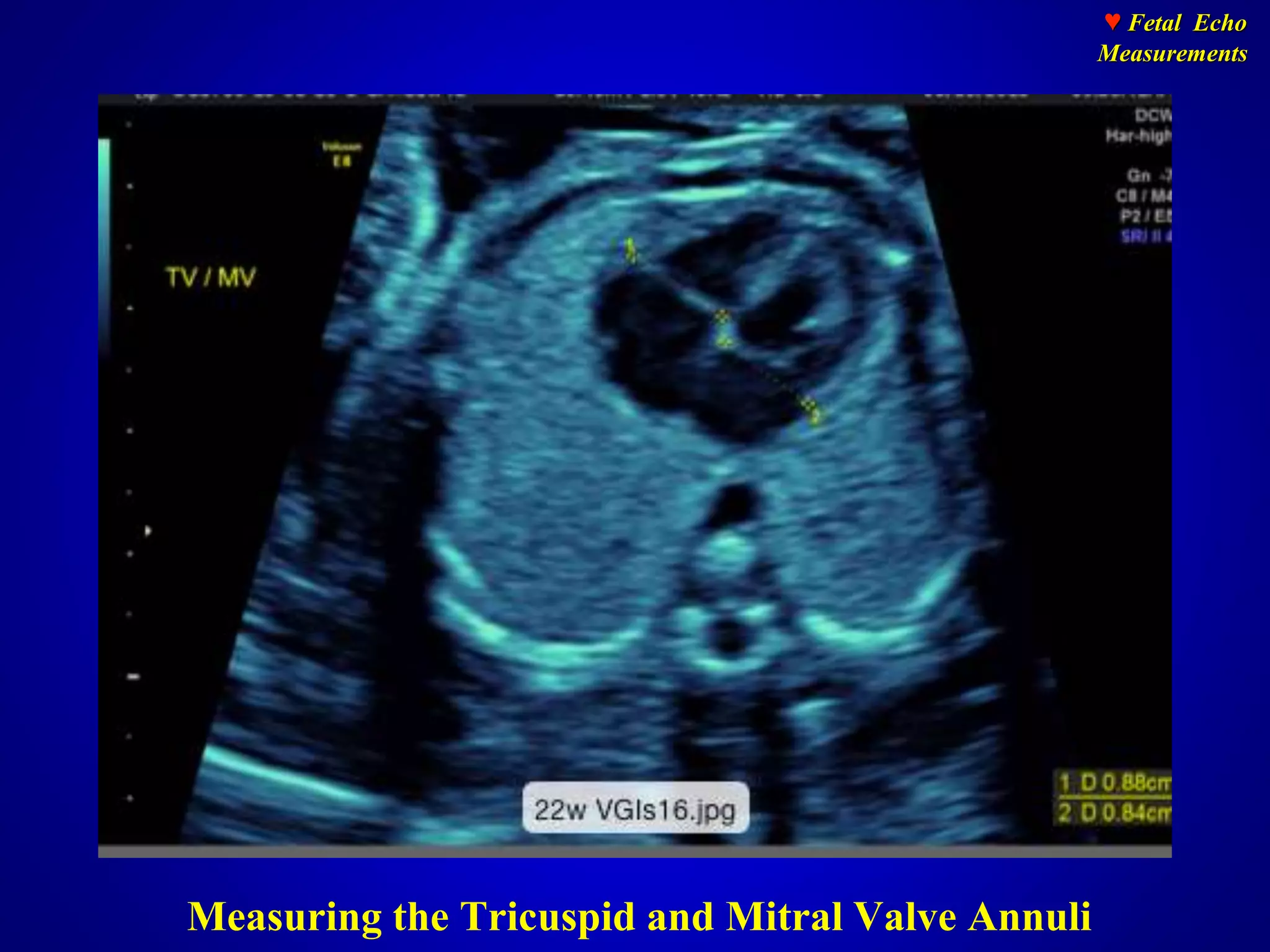 Fetal echo measurments | PPTX