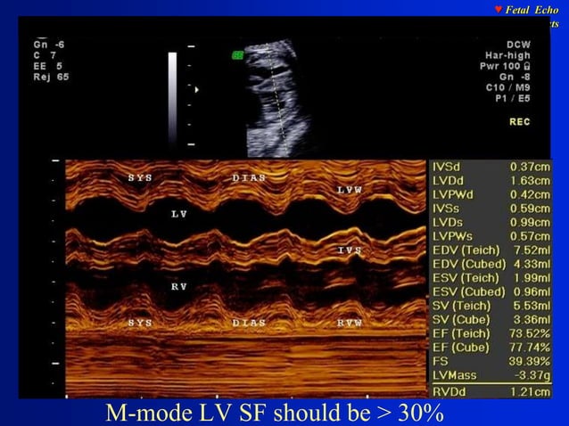 Fetal echo measurments | PPTX | Heart and Cardiovascular Diseases | Diseases and Conditions
