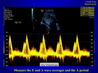 Fetal echo measurments | PPTX
