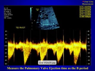 Fetal echo measurments | PPTX