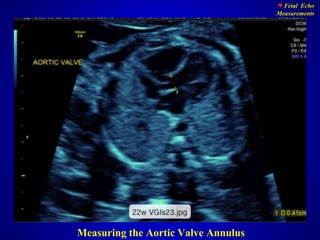 Fetal echo measurments | PPTX