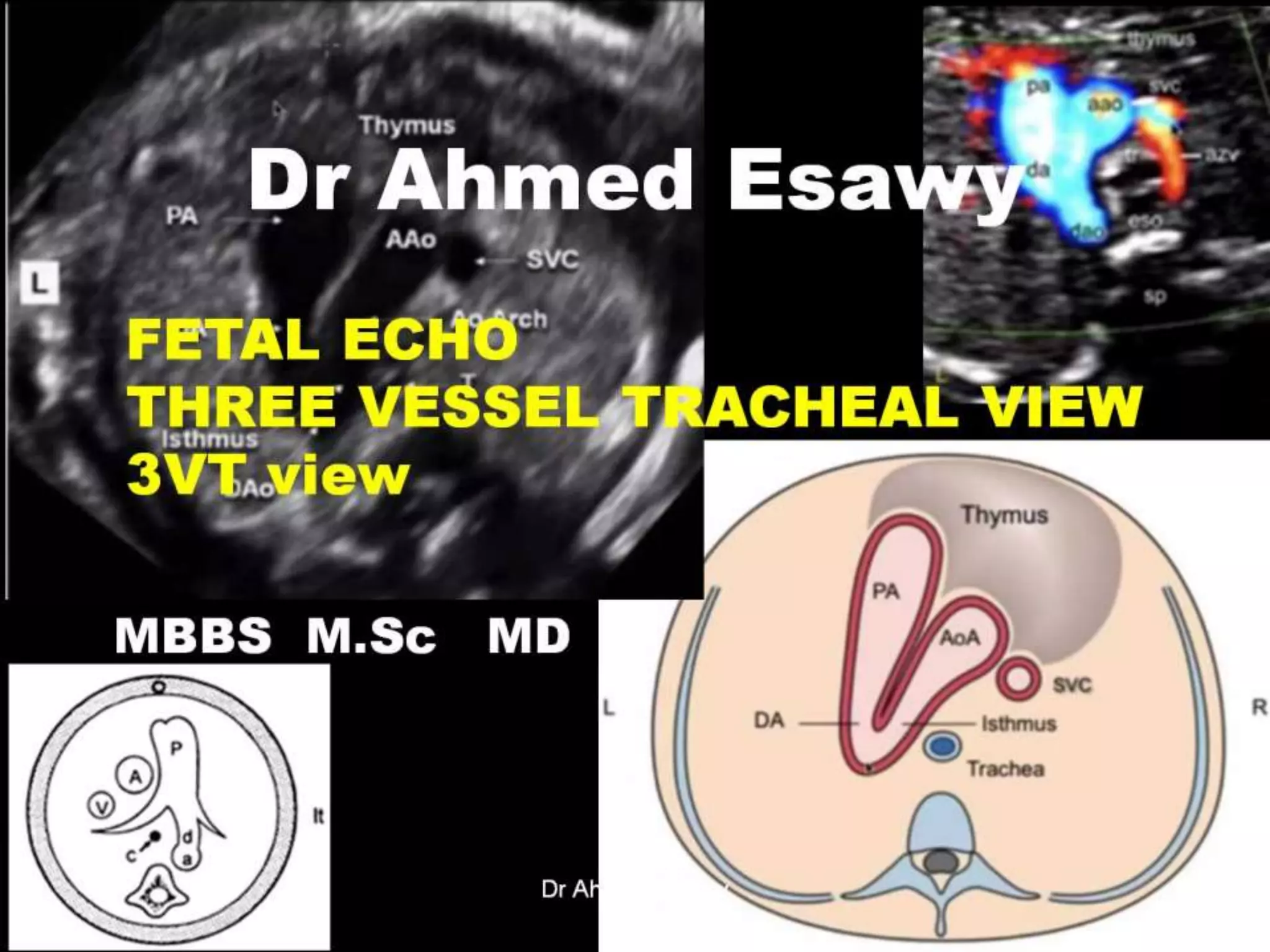 Fetal echo three vessel trachea view 3 vt dr ahmed esawy | PPTX