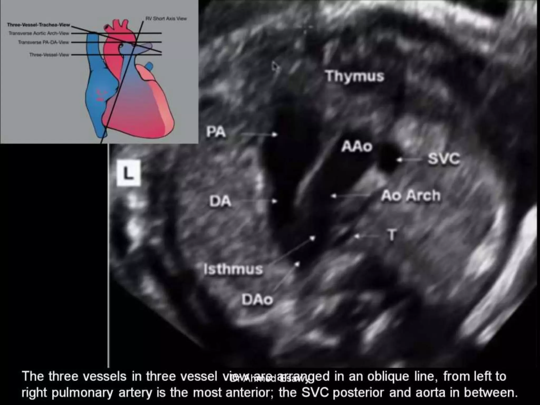 Fetal echo three vessel trachea view 3 vt dr ahmed esawy | PPTX