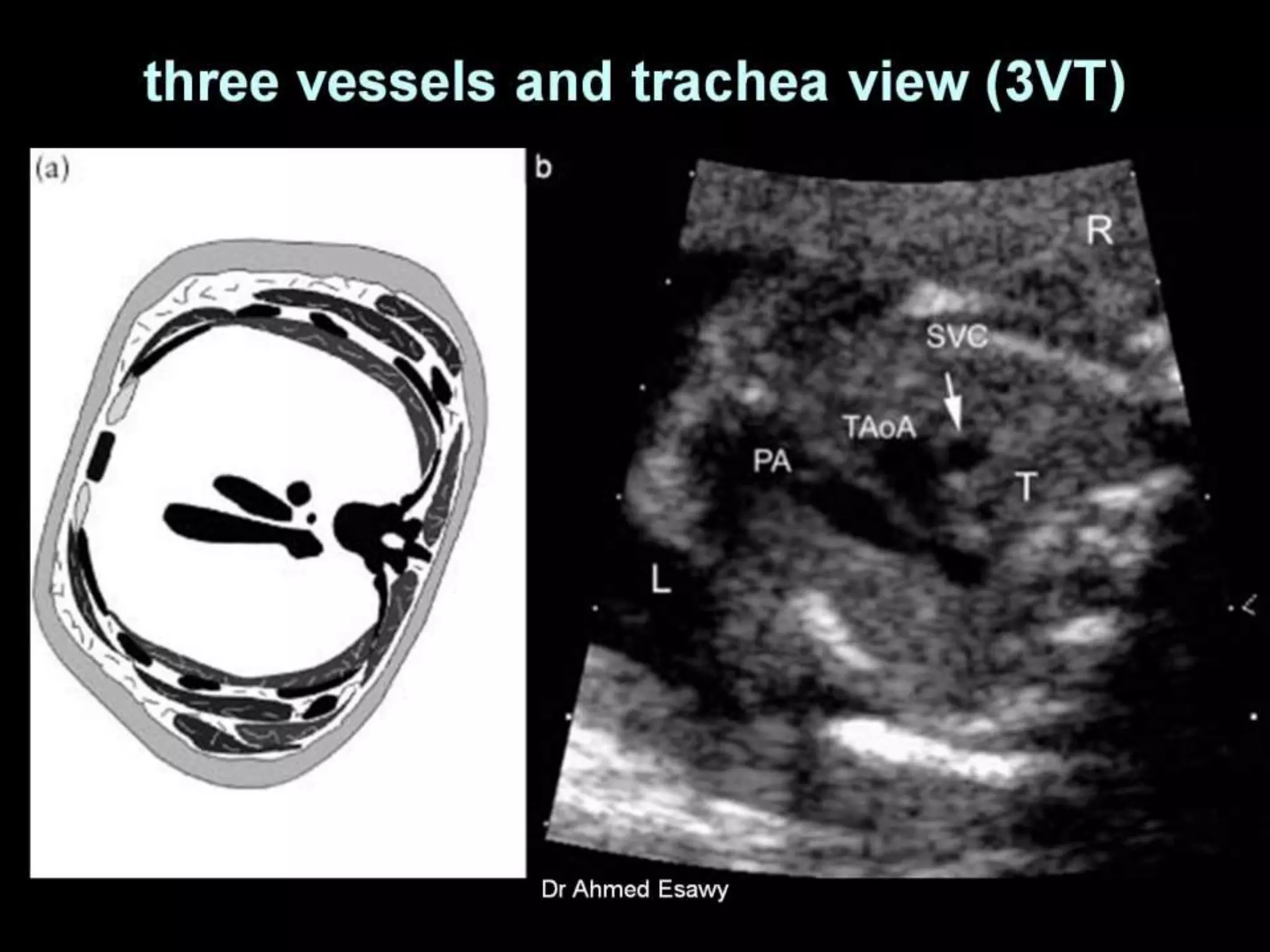 Fetal echo three vessel trachea view 3 vt dr ahmed esawy | PPTX