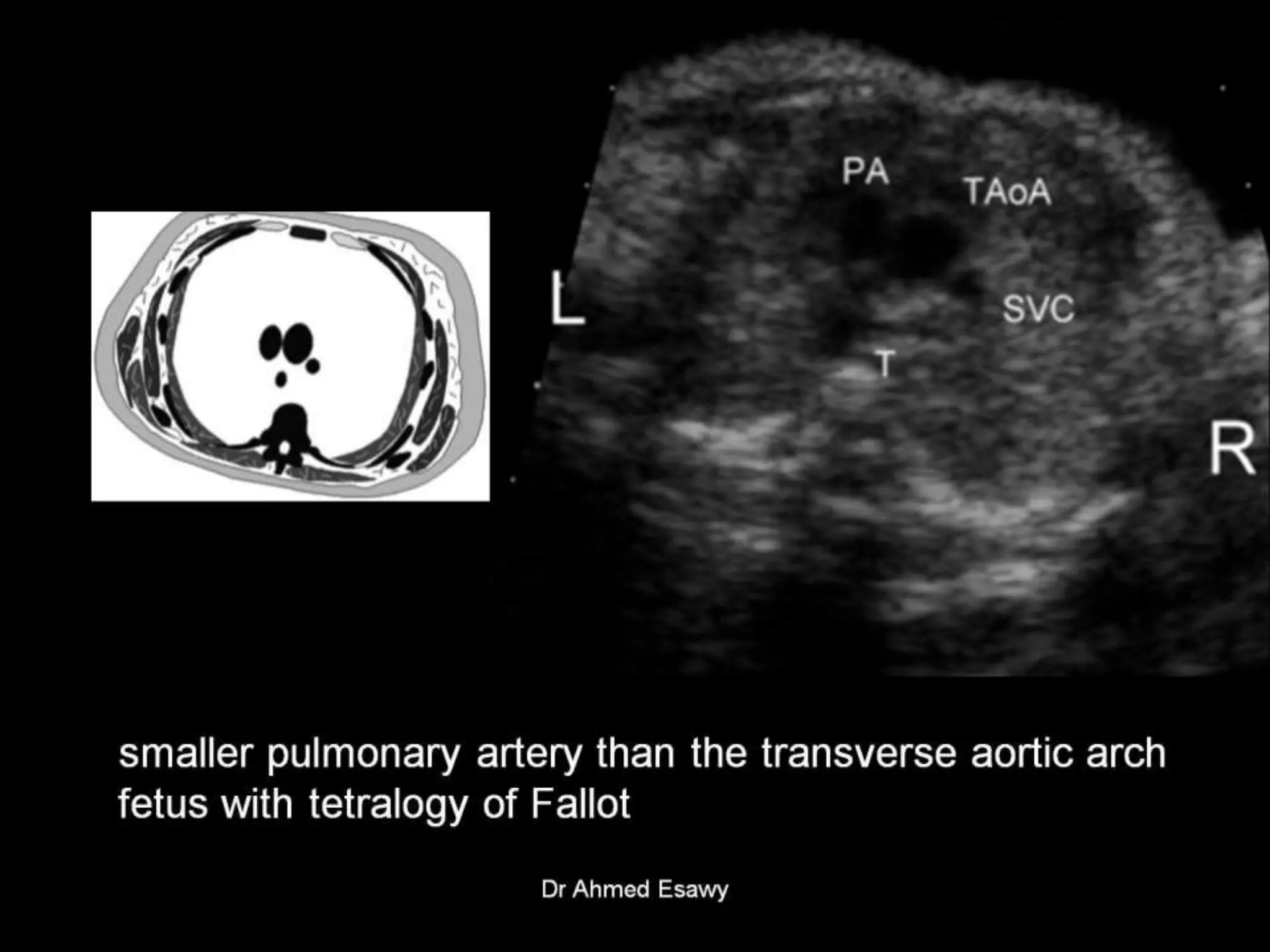 Fetal echo three vessel trachea view 3 vt dr ahmed esawy | PPTX