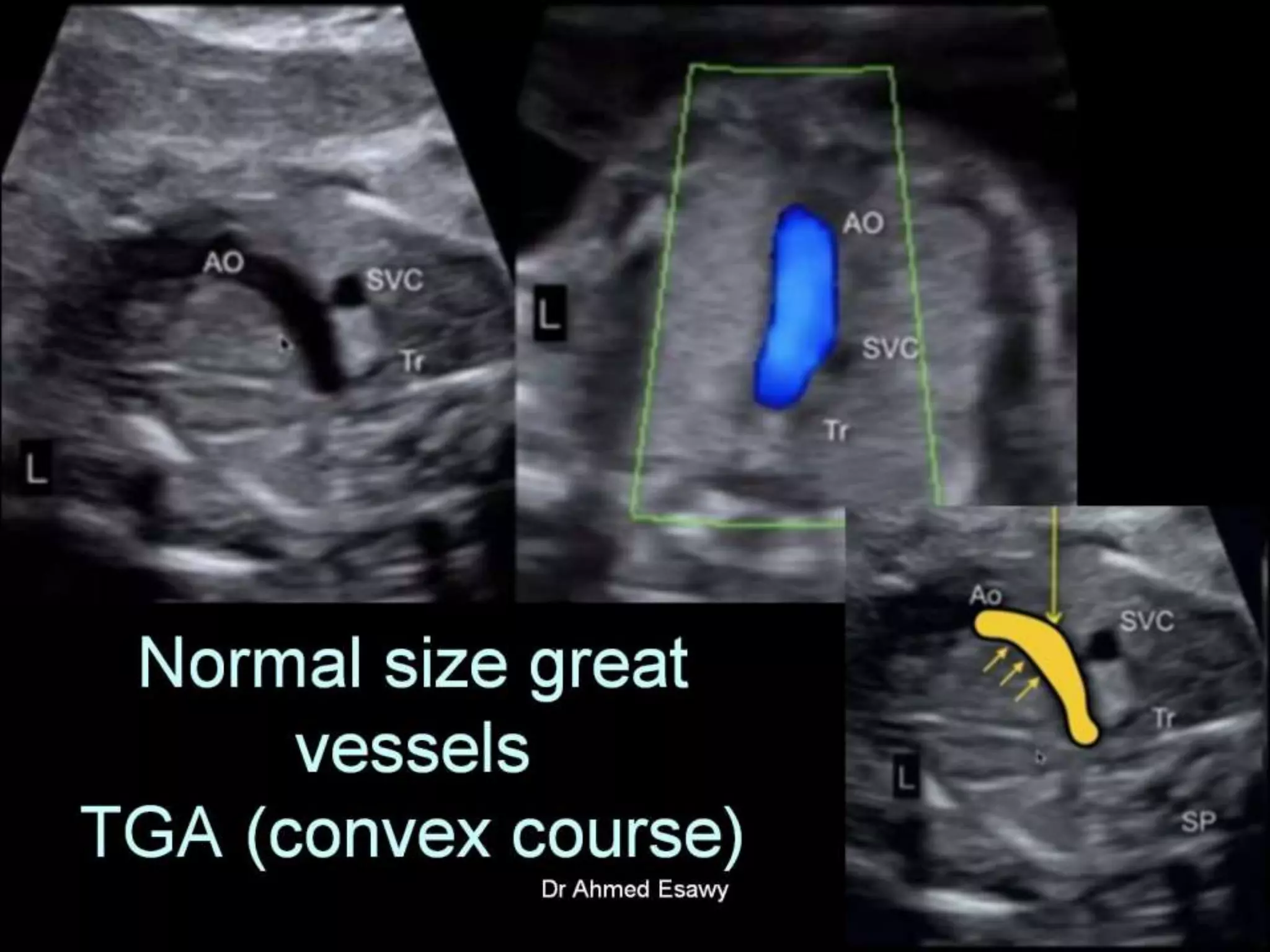 Fetal echo three vessel trachea view 3 vt dr ahmed esawy | PPTX