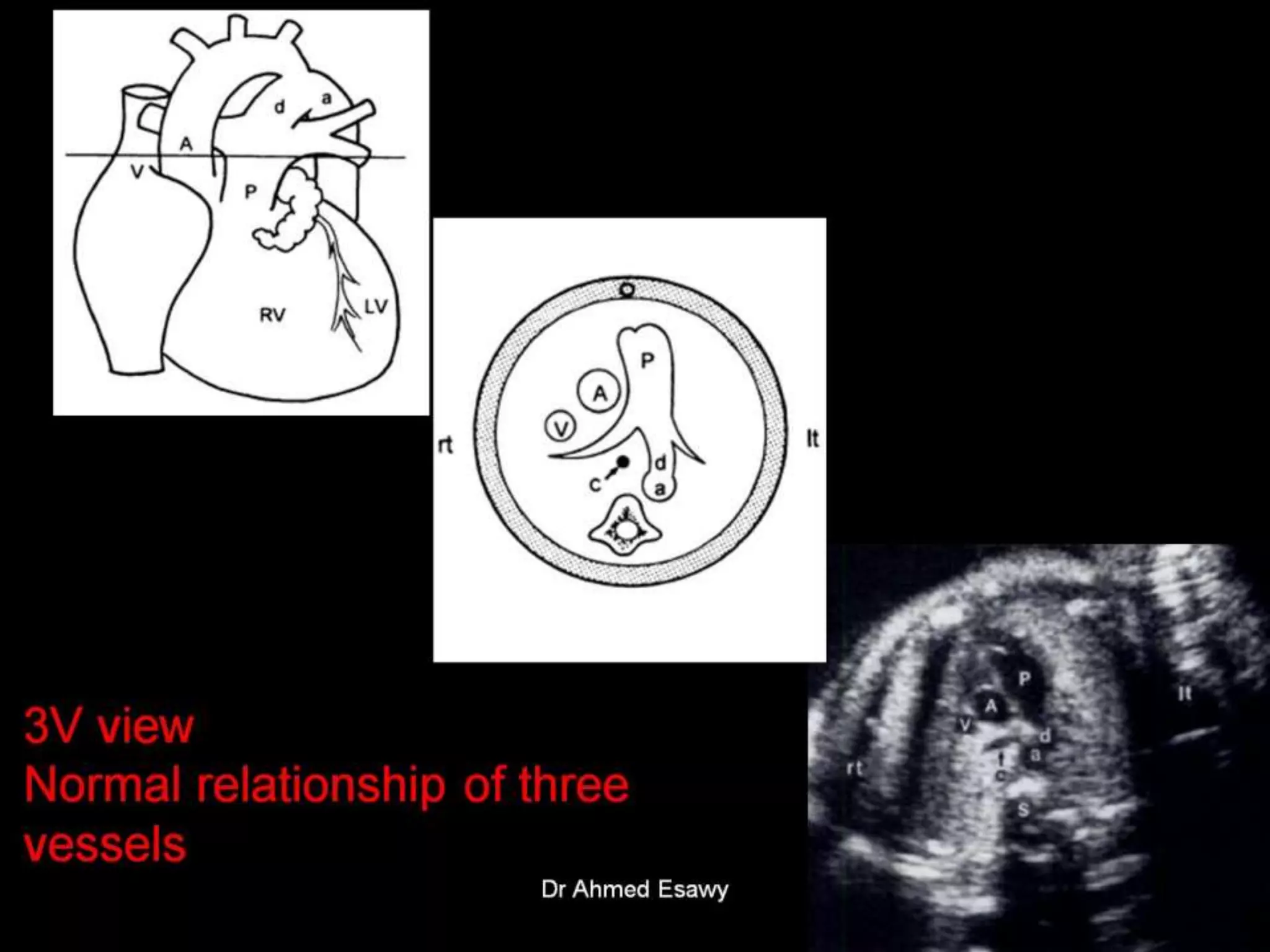 Fetal echo three vessel trachea view 3 vt dr ahmed esawy | PPT