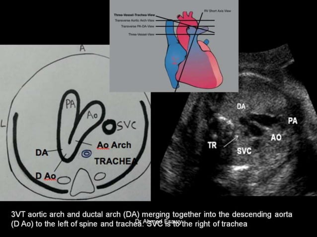 Fetal echo three vessel trachea view 3 vt dr ahmed esawy | PPT