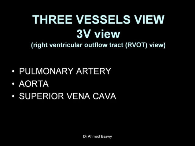 Fetal echo three vessel trachea view 3 vt dr ahmed esawy | PPT