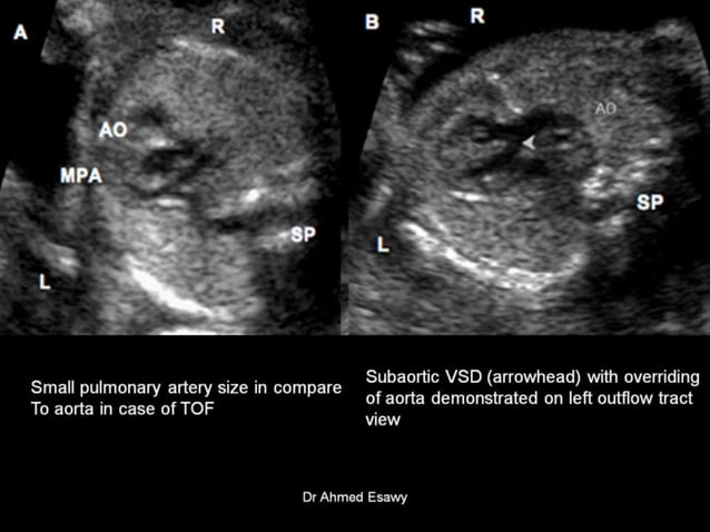 Fetal echo three vessel trachea view 3 vt dr ahmed esawy | PPT