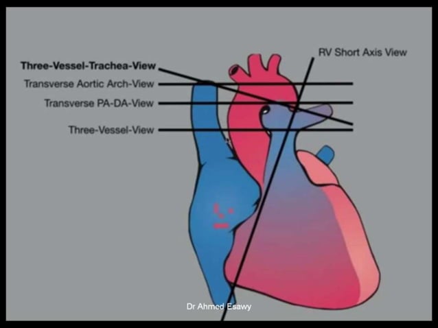 Fetal echo three vessel trachea view 3 vt dr ahmed esawy | PPT