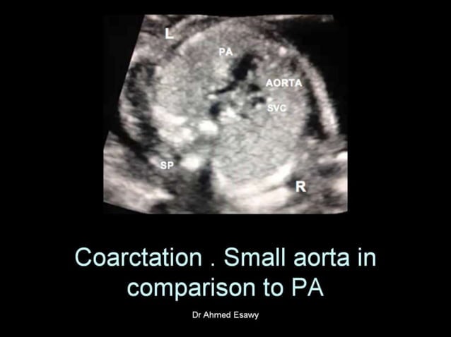 Fetal echo three vessel trachea view 3 vt dr ahmed esawy | PPT