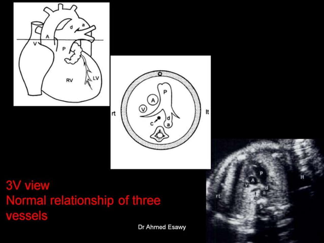 Fetal echo three vessel trachea view 3 vt dr ahmed esawy | PPT