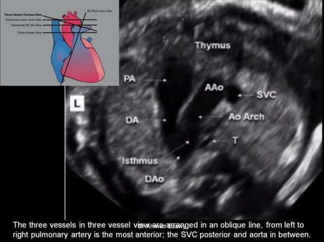 Fetal Echo Three Vessel Trachea View 3 Vt Dr Ahmed Esawy