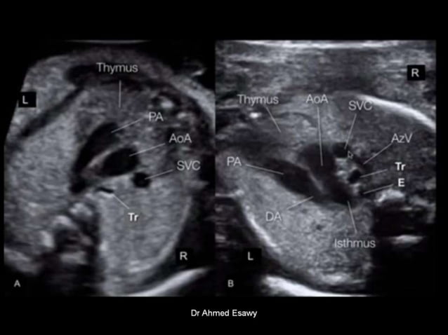 Fetal echo three vessel trachea view 3 vt dr ahmed esawy