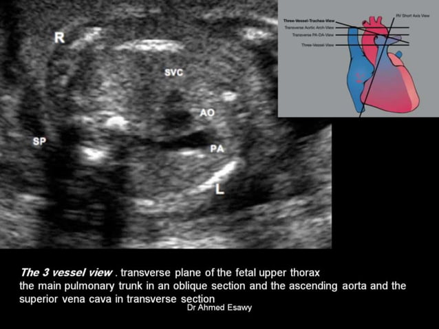 Fetal echo three vessel trachea view 3 vt dr ahmed esawy