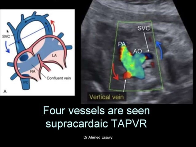Fetal echo three vessel trachea view 3 vt dr ahmed esawy