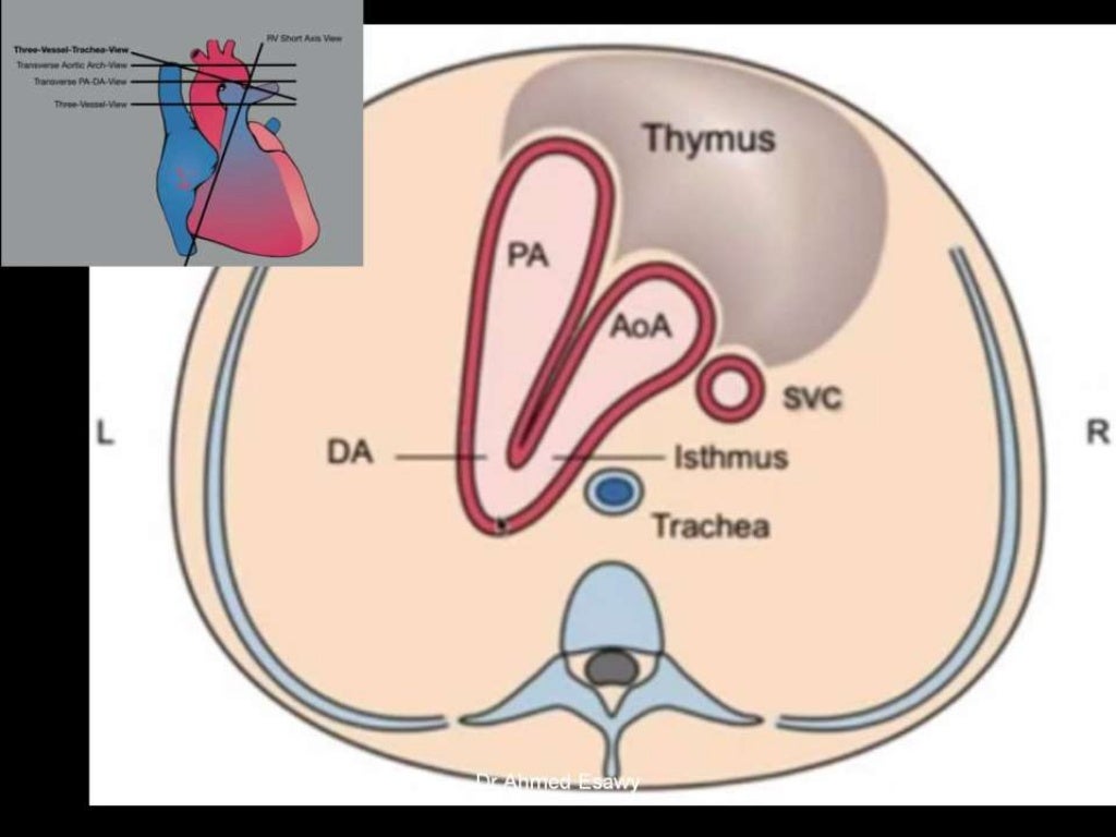 Fetal Echo Three Vessel Trachea View 3 Vt Dr Ahmed Esawy